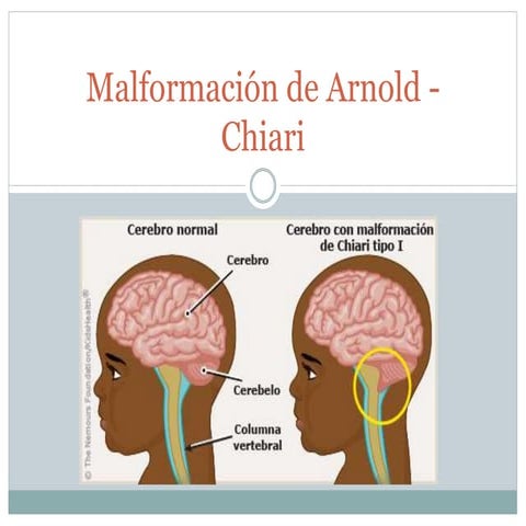 Arnorld chiari.ppt