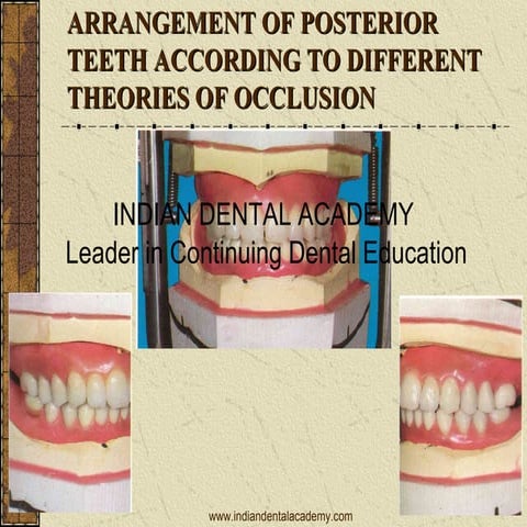 ARRANGEMENT OF POSTERIOR TEETH ACCORDING TO DIFFERENT THEORIES OF ...