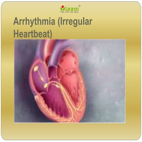 Arrhythmia (irregular heartbeat) | PPTX