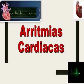 Arritmia cardiaca | PPTX