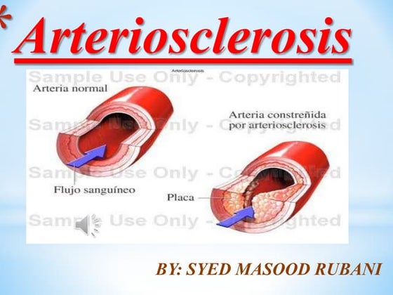 Atherosclerosis | PPT