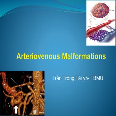 Arteriovenous malformations | PPTX