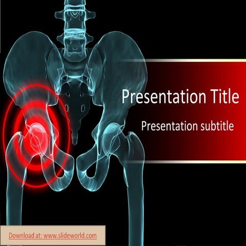 Arthritis Powerpoint template | PPT