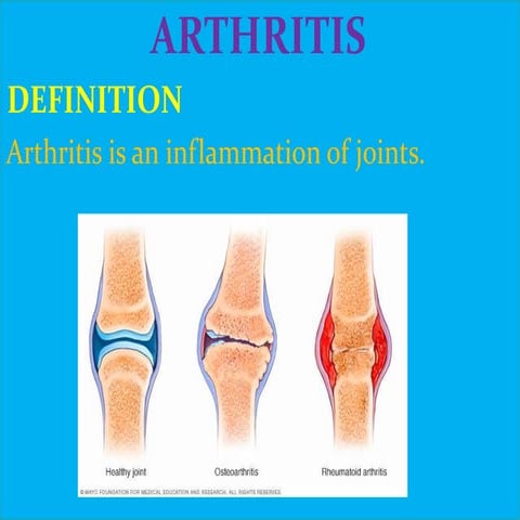 Arthritis.pptx