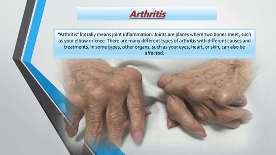 Pathophysiology of Rheumatoid Arthritis.pptx