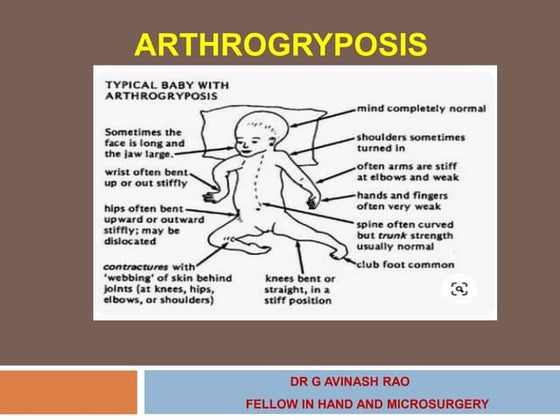 Arthrogryposis Multiplex Congenita | PPT