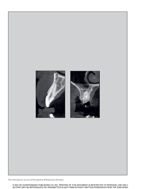 Immediate Placement and Provisionalization of Maxillary Posterior Single Implants | PDF