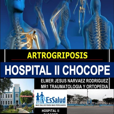 ARTROGRIPOSIS MÚLTIPLE CONGÉNITA GENETICA.pptx