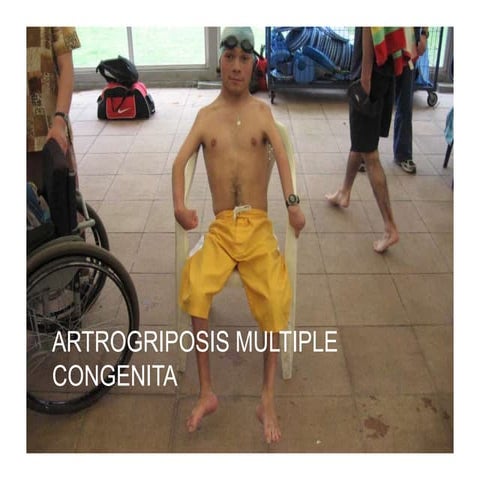 Artrogriposis.ppt