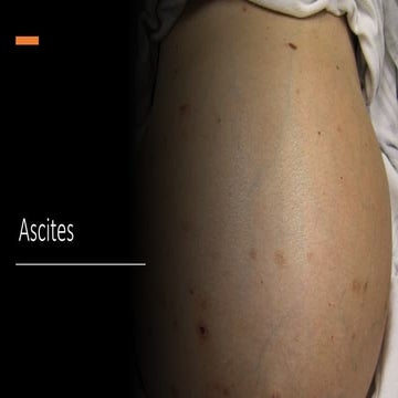 Ascites - Intro, Causes, Pathophysiology , Signs and Symptoms ...