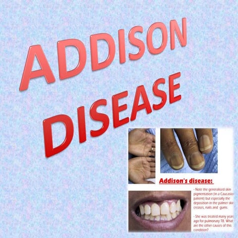 Auhan Keperawatan Addison Disease .ppt