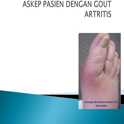 ASKEP PASIEN DENGAN GOUT ARTRITIS | PPTX