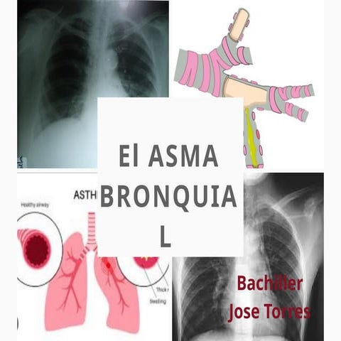 Tratamiento del asma bronquial y sus categorías | PPTX