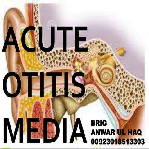 Acute Otitis Media | PPTX