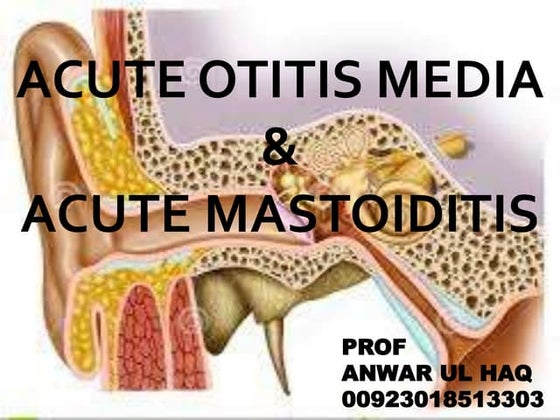 Acute otitis media | PPT