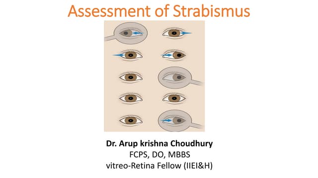 Hirschberg test | PPTX