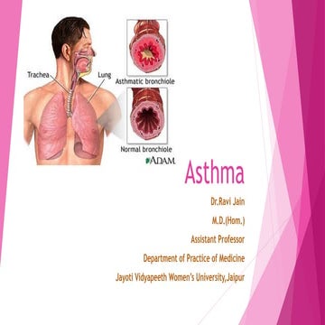 Asthma | PPT