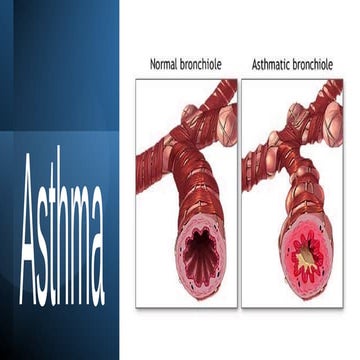 Asthma, definition, causes, pathophysiology and symptoms | PPTX