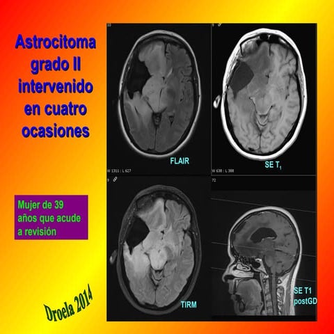 Astrocitoma grado II intervenido en cuatro ocasiones | PPT
