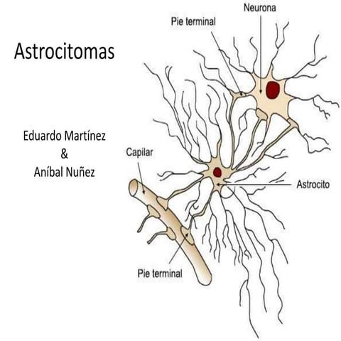 Astrocitomas | PPTX