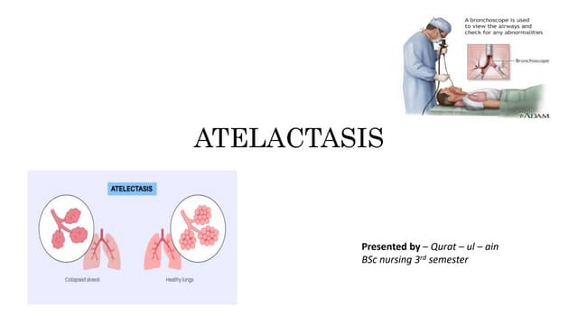 Atelectasis | PPTX