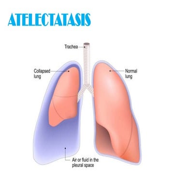 atelectasis. power point presentation for nurses | PPT