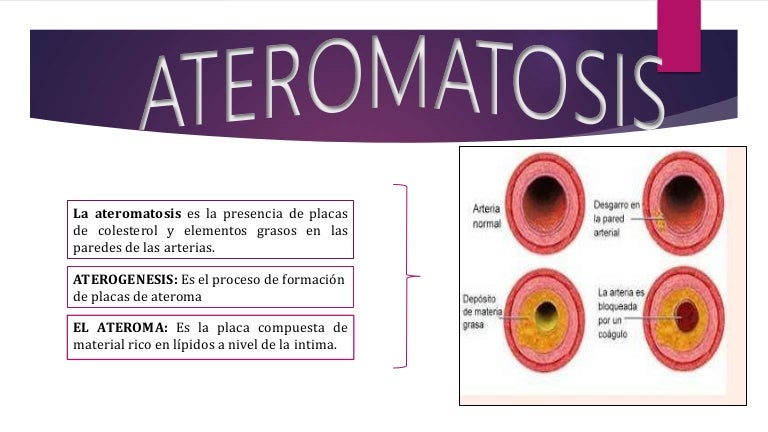 Ateromatosis