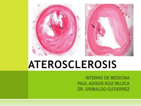 Atherosclerosis | PPTX | Heart and Cardiovascular Diseases | Diseases ...
