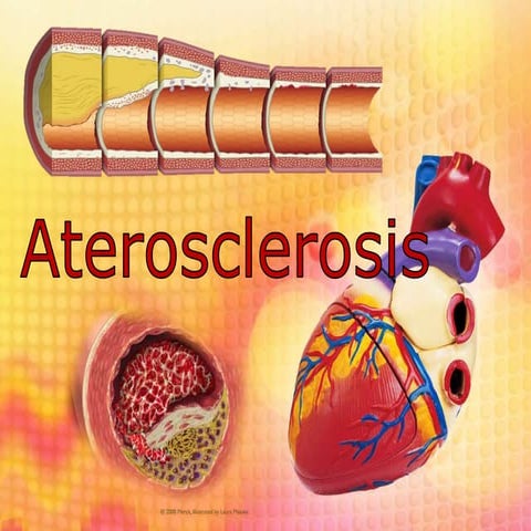 Aterosclerosis | PPTX