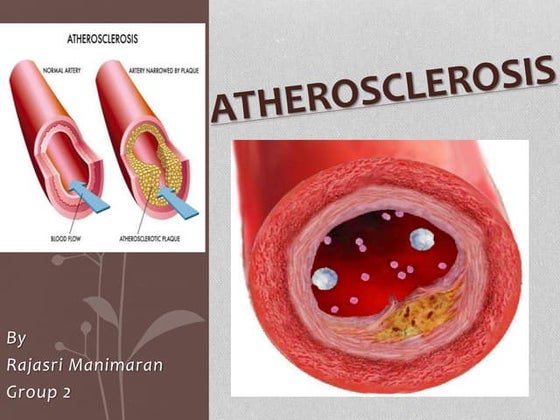 Atherosclerosis | PPT