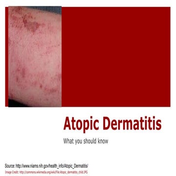 Atopic Dermatitis | PPTX