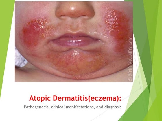 Atopic dermatitis. Presentation in pediatric case | PPT