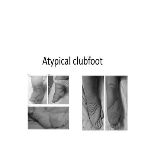 Atypical clubfoot, complex ctev, dx.pptx