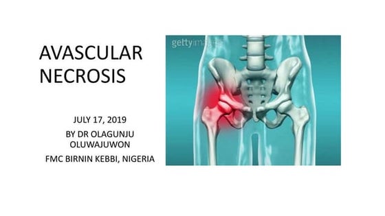 Femoral Head Avascular Necrosis | PPT
