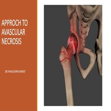 Avascular necrosis Radiology | PPTX