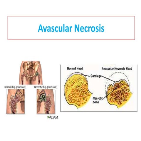 Avascular necrosis ug class | PPTX
