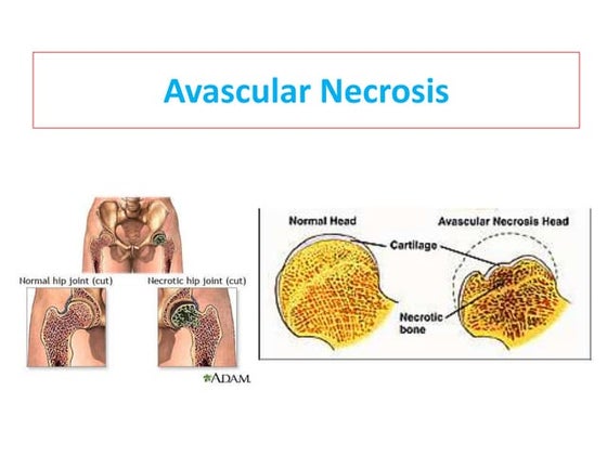 Avascular necrosis of hip joint | PPTX