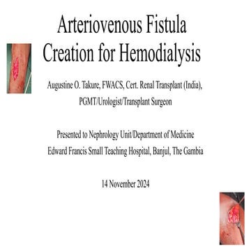 Arteriovenous fistula creation for hemodialysis | PPTX