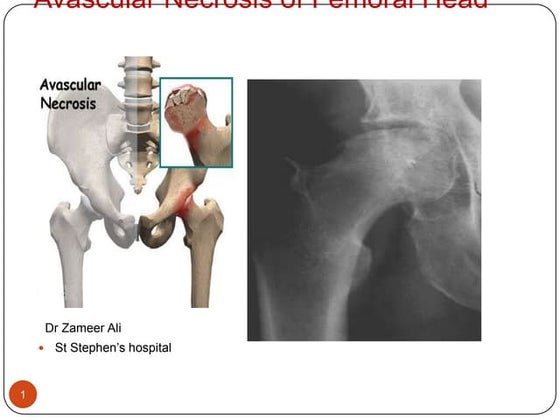 Avascular Necrosis (AVN) | PPTX