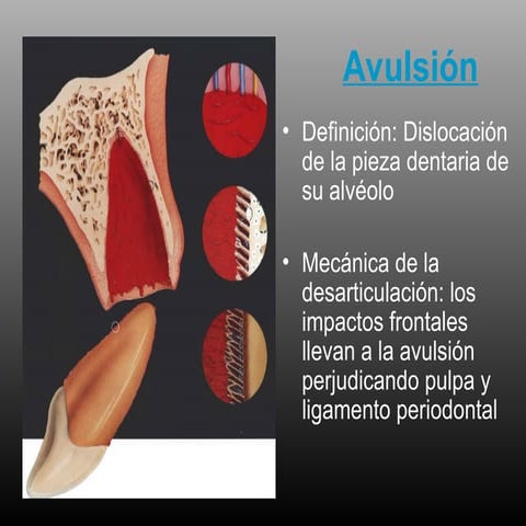 TRAUMATISMOS DENTALES: AVULSION DENTAL | PPT