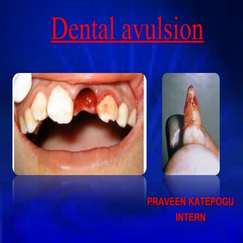 Avulsion | PPT