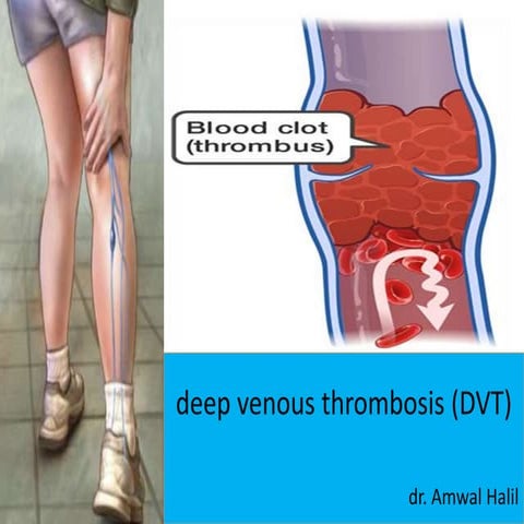 Deep vein thrombosis (DVT) | PPTX