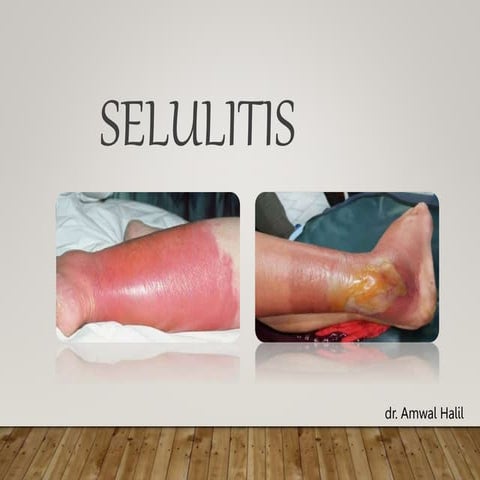 AW Tugas PPT Selulitis, dan tatalaksana.pptx