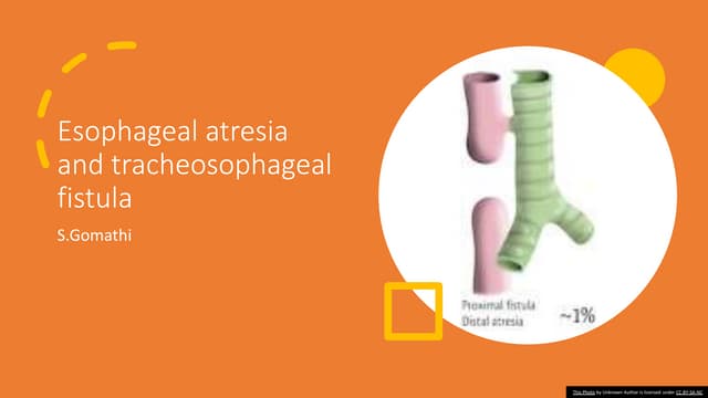 Tracheoesophageal Fistula Ppt
