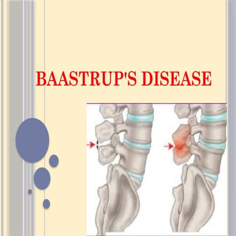 Baastrup Syndrome: Physiotherapy Management | PPTX
