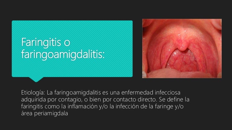 Faringitis o faringoamigdalitis
