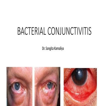 Eye disease Bacterial conjuctivitis.pptx