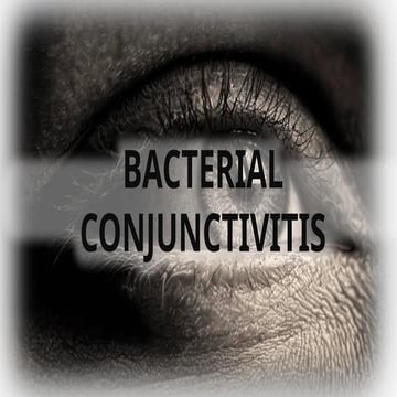bacterial conjunctivitis.pptx jjjjjjjjjjjjjjjjjjjjjjjjjjjjjjjjjjjjjjj | PPTX