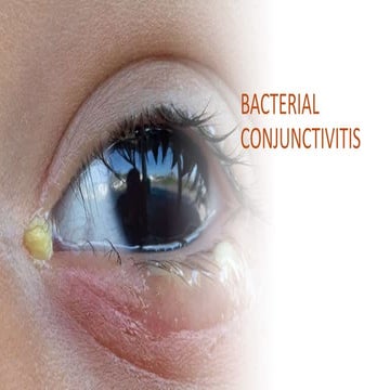 BACTERIAL_CONJUNCTIVITIS, Ocular microbiology | PPTX