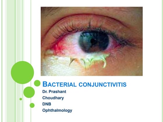 Bacterial Conjunctivitis Pediatric Acute Bacterial Conjunctivitis: An